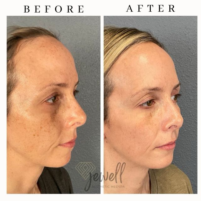 How Long Does BOTOX® Take To Work: What To Know Before, During & After ...