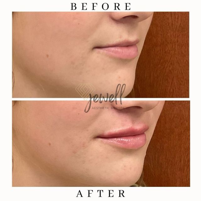 Can BOTOX® Compete With a Brow Lift? - Jewell Aesthetic Med Spa